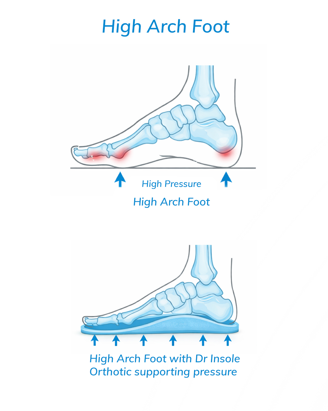 High Arches in Teens – Dr. Insole